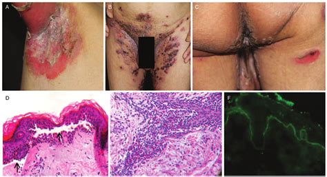 Bullous Pemphigoid Developed In A Patient With Chronic Benign Familial