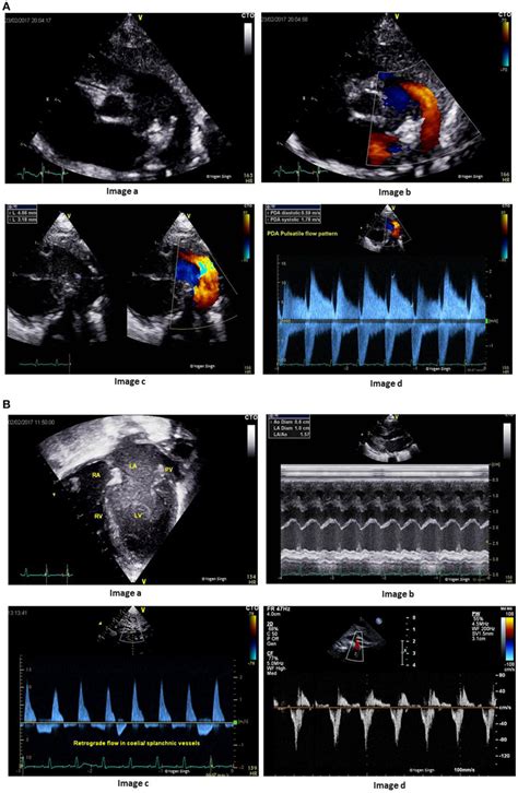 A Assessment Of Patent Ductus Arteriosus PDA Image A Shows PDA Download Scientific