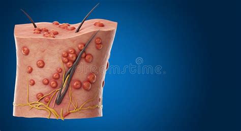 Detailed 3d Medical Illustration Of Cutaneous Leishmaniasis Showing Red