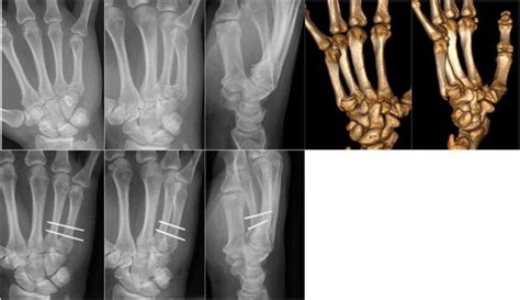 Multifragmentary Cmc Base Fracture With Dorso Ulnar Dislocation In Download Scientific Diagram