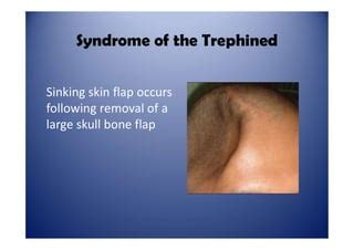 Stroke Care Of Patient With Post Decompressive Craniectomy Pdf