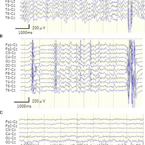 Panel A Interictal Electroencephalography Eeg On Day 1 Download Scientific Diagram