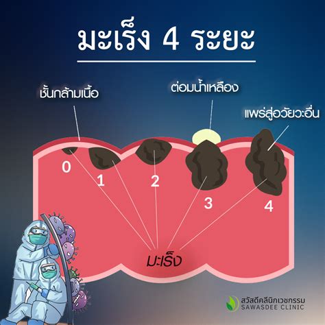 โรคมะเร็ง ระยะต่างๆ Sawasdee Clinic สวัสดีคลินิกเวชกรรม