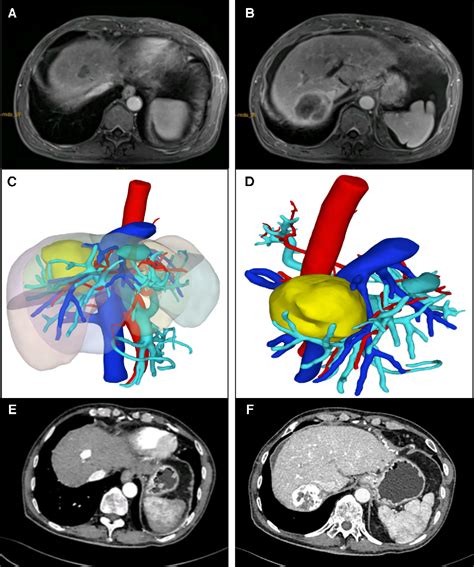 Figure 2 From Downstaging And Laparoscopic Hepatectomy Plus