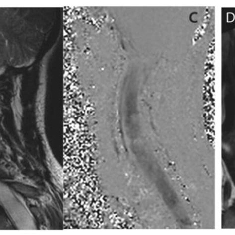 Shunting Revision After Chiari Decompression Failure Case Of A 20