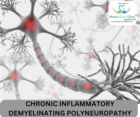 Cidp Symptoms Causes And Best Homeopathic Remedies For Treatment