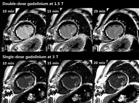 Subendocardial Infarction Observed In Septal Inferior And Lateral Wall Download High