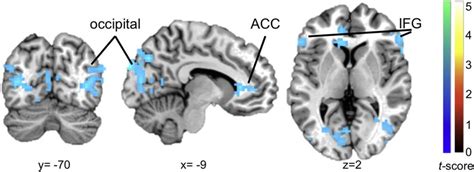 Task Related Functional Connectivity Analyses For The Bilateral