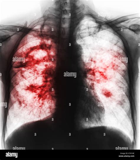 Pulmonary Tuberculosis Film X Ray Of Chest Show Cavity At Right Lung