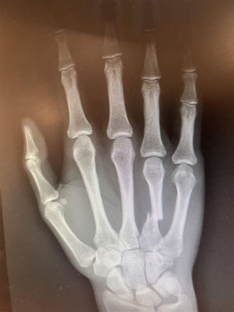 Silly Metacarpal Fracture R Radiology