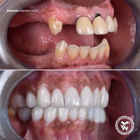 Bite Correction Atlantic Dental Clinic