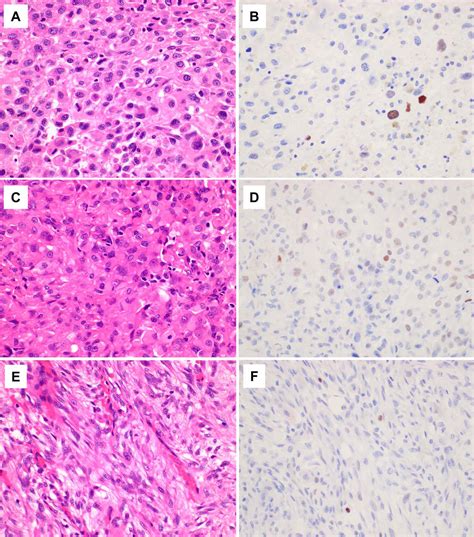 Recurrent Fos Rearrangement In Proliferative Fasciitis Proliferative Myositis Modern Pathology