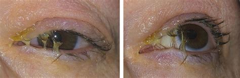 Purulent Drainage From Eye
