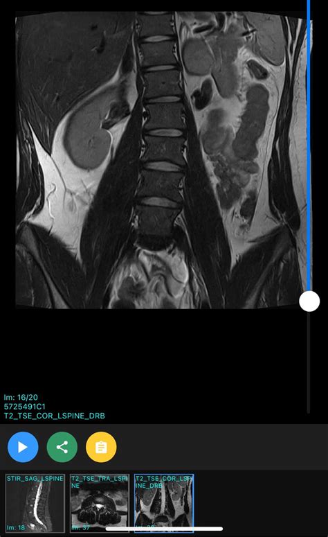 L51 Grade 1 Retrolisthesis Annular Fissure And A Broad Based Disc