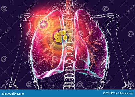 Primary Lung Tuberculosis 3d Illustration Stock Illustration Illustration Of Technology