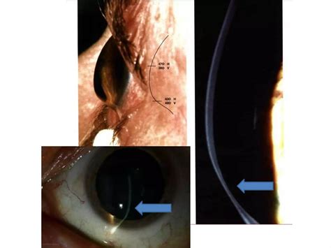 Disorders Of Cornea Ectatic Disorders Corneal Dystrophy And