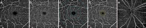 Presentation Of An Image Of Macular Superficial Capillary Plexus Vessel Download Scientific