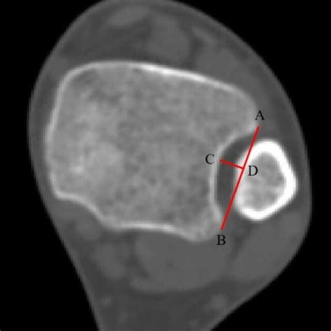 This Cross Section Is Located At 1 Cm Proximal To The Distal Tibial Download Scientific Diagram