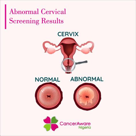 Normal Vs Abnormal Cervix
