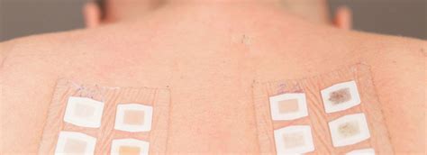 Patch Testing For Skin Allergies Columbia Skin Clinic