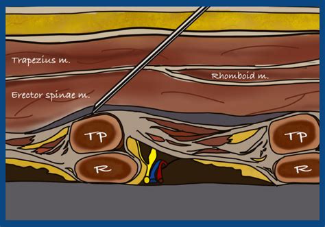 Discover The Versatility Of Erector Spinae Plane Block