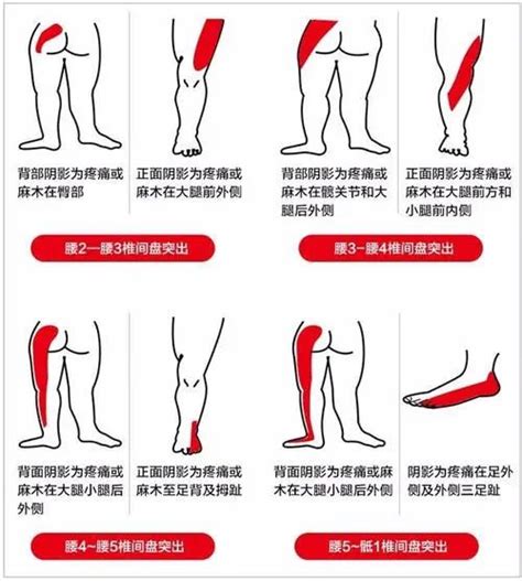 腰34、腰45、腰5骶1都有椎间盘突出，那这些节段都需要处理吗？症状突出患者判断椎间盘 健康界
