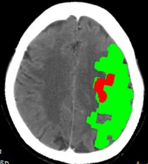 Ct Perfusion Imaging Images Reconstructed By Post Processing Software Download Scientific