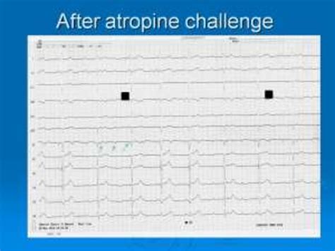 Figure 2 From Importance Of Atropine Challenge Test In The Current Era Of Electrophysiology