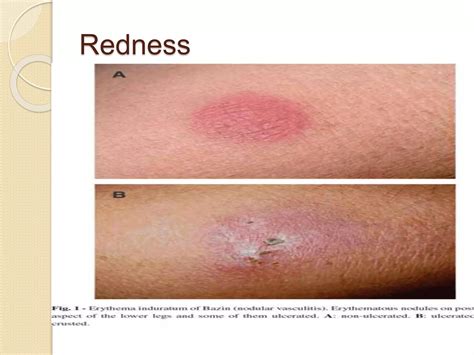 Intradermal Injection Introduction Procedure Complications Pptx