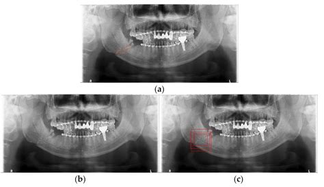 Automatic Detection Of Mandibular Fractures In Panoramic Radiographs Using Deep Learning