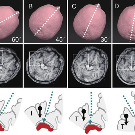 Fiber Tracts In The Temporal Stem A Lateral View Of The Left Temporal Download Scientific