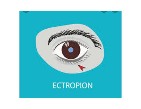 Ectropion Eye Disease Bscoptometry Studocu