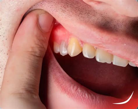 Jaw Abscess Doctor Explains Dental Abscess Tooth Abscess Causes