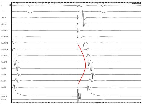 Atrial Flutter Diagnosis Management And Treatment IntechOpen