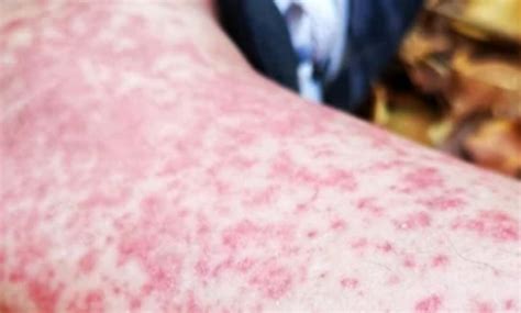 Vasculite Por Iga Dra Clarice Moura