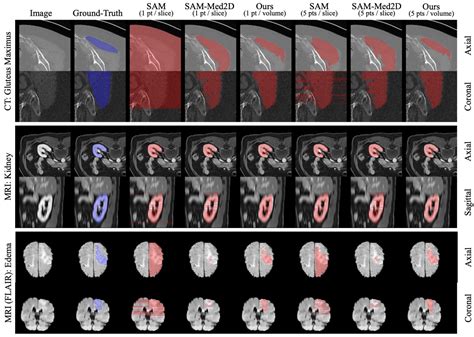 Sam Med3d：三维医学图像上的通用分割模型，医疗版三维 Sam 开源了！ 知乎