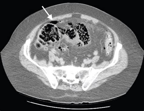 When Constipation Reaches Its Breaking Point