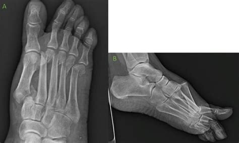 Ossiofiber® Orif Of 1st Tmt Fracture Dislocation And 2 5 Metatarsal Fractures