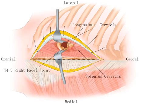 Surgical Diagram Hand Drawing For The Anatomy Of The Paraspinal