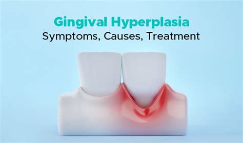 Gingival Hyperplasia Symptoms Causes Treatment