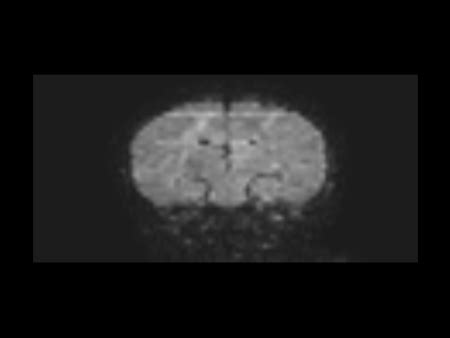 Summer Project Week Longitudinal Patient Specific DTI Analysis NAMIC Wiki