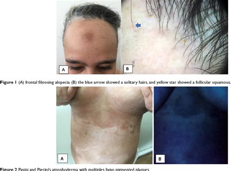 Figure 1 From Pasini Pierinis Atrophoderma And Frontal Fibrosing Alopecia An Unusual