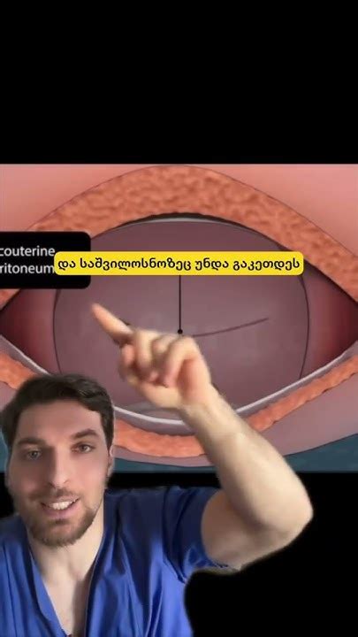 საკეისრო კვეთა მედიცინა სამედიცინო ექიმი Youtube