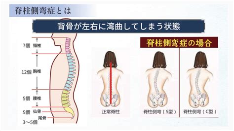 【脊柱側弯症】原因・症状・治療法｜装具・手術・予防まで紹介 医療法人社団月山会 おやま整形外科クリニック