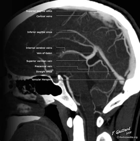 Confluence Of Sinuses Radiology Reference Article Sinusitis Radiology