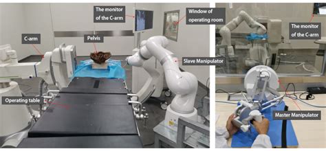 A Teleoperated Robotic System Assisted Percutaneous Transiliac Transsacral Screw Fixation