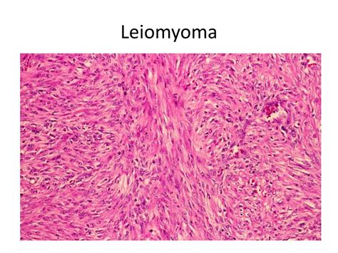 Ppt 3 Leiomyoma Powerpoint Presentation Free Download Id2234658