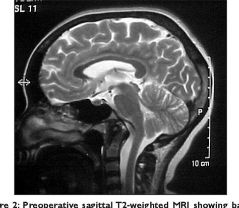 Figure 2 From Trigeminal Neuralgia Secondary To Basilar Impression A