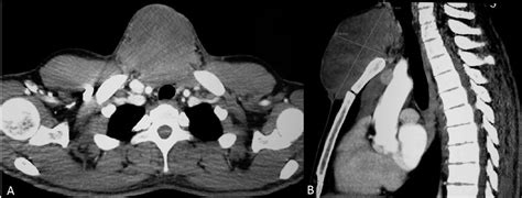 En Bloc Resection Of Soft Tissue Sarcoma Of Anterior Chest Wall And