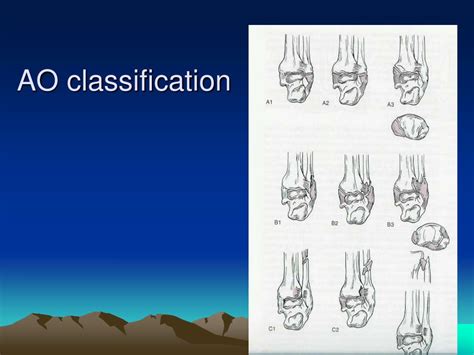 Ppt Foot And Ankle Fractures Powerpoint Presentation Free Download
